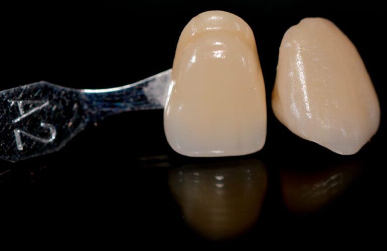 ceramica-feldspática - Labordental - Transformando o sorriso em estilo ...